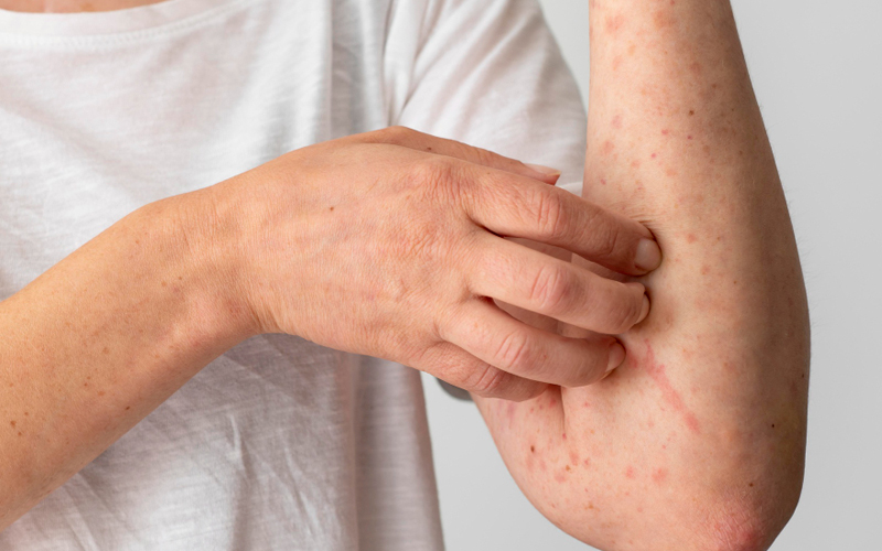 Morbili haraju RS-om: U manjem bh. entitetu čak 135 zaraženih, najviše ...